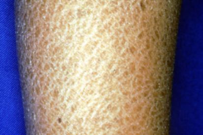 Dry Skin: Symptoms and Treatment | Lupton Dermatology